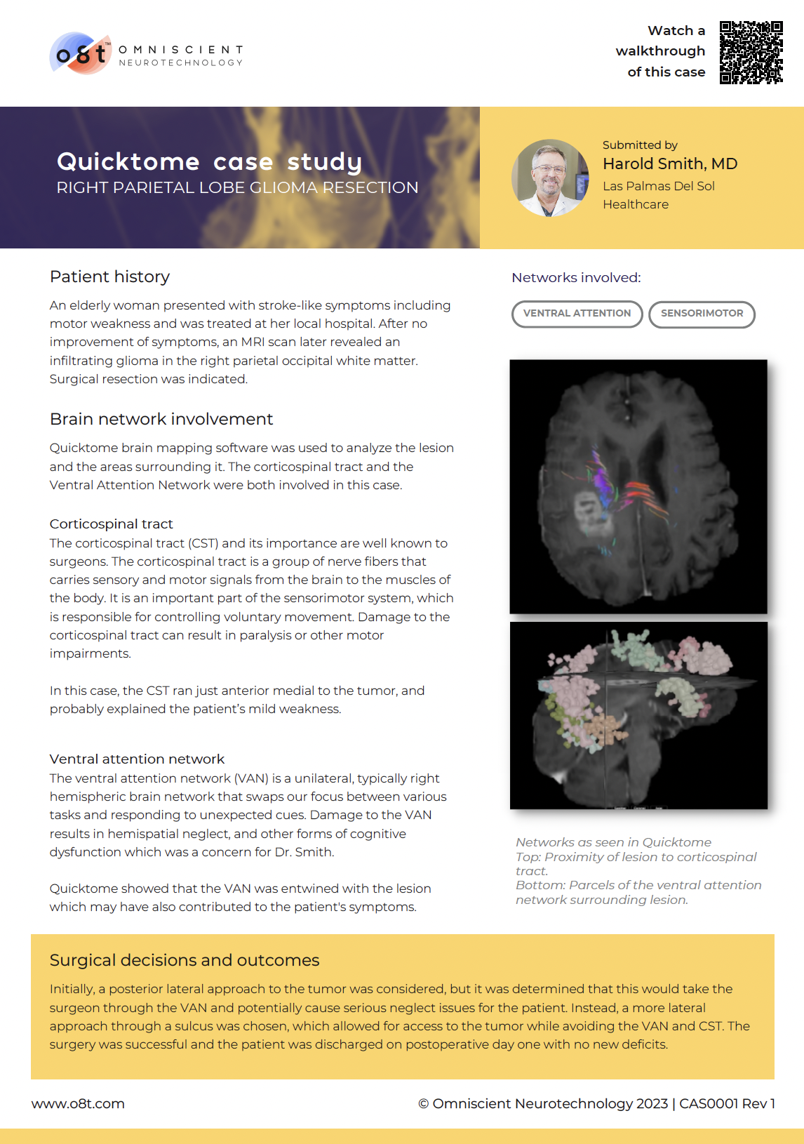 Right parietal lobe glioma resection